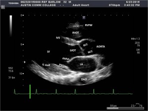 Parasternal Window | Sonography Resources