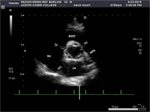 Parasternal Window | Sonography Resources