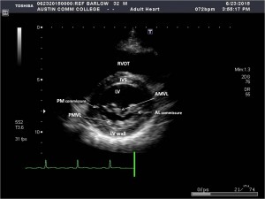Parasternal Window | Sonography Resources