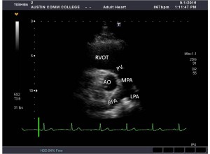 Parasternal Window | Sonography Resources