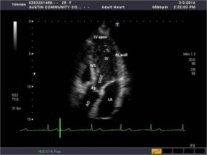 Apical Window | Sonography Resources