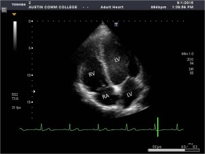 Apical Window | Sonography Resources