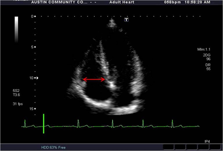 Apical Window | Sonography Resources