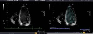 Apical Window | Sonography Resources