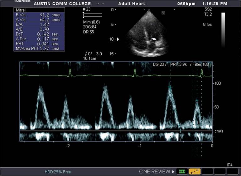 Apical Window | Sonography Resources