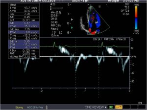Apical Window | Sonography Resources